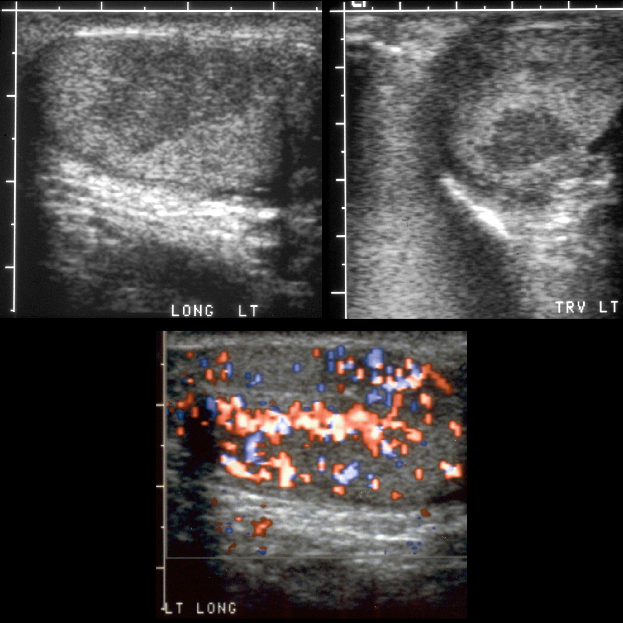 Pediatric Epididimo-Orchitis | Pediatric Radiology Reference Article ...