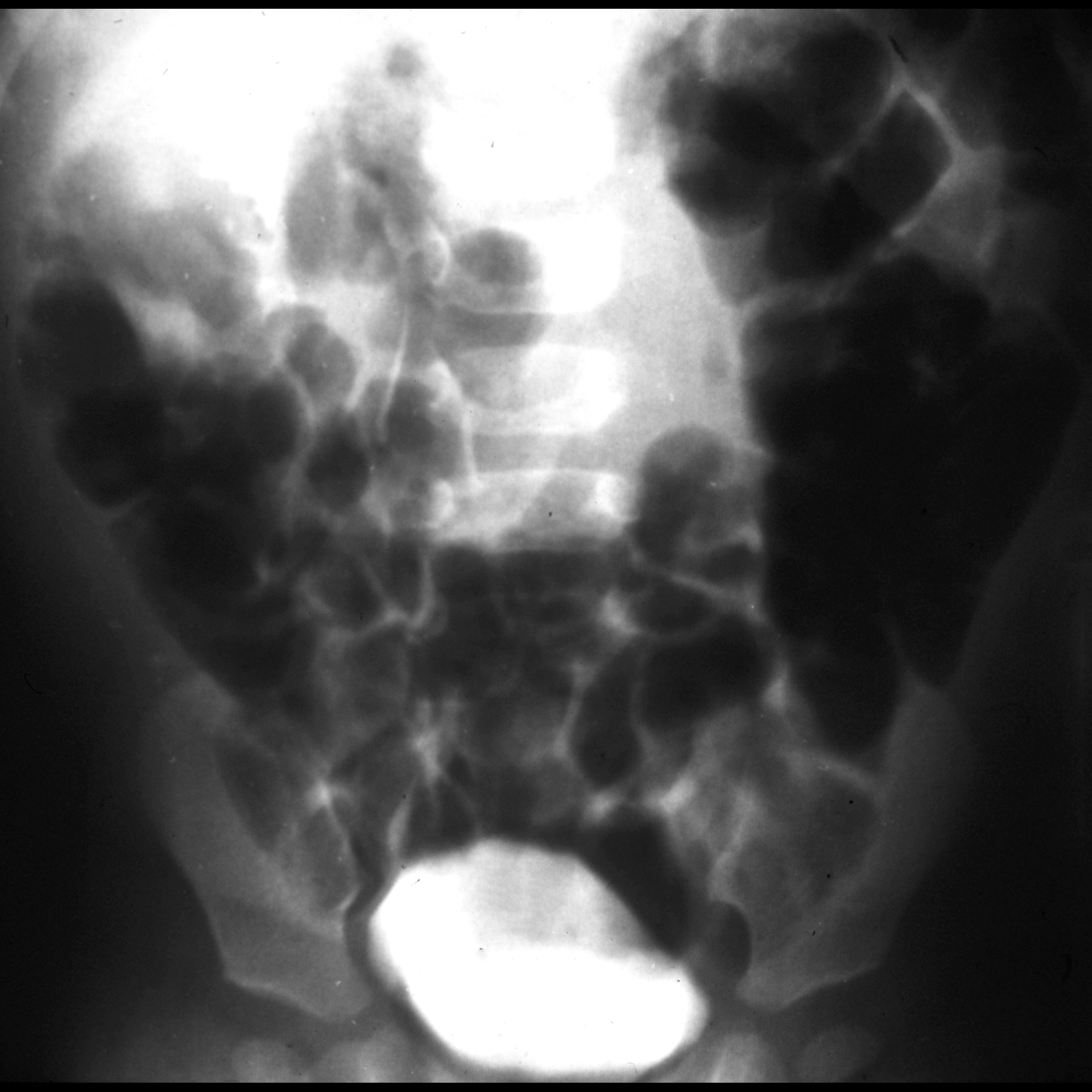 Agenesis of Kidney | Pediatric Radiology Reference Article | Pediatric ...