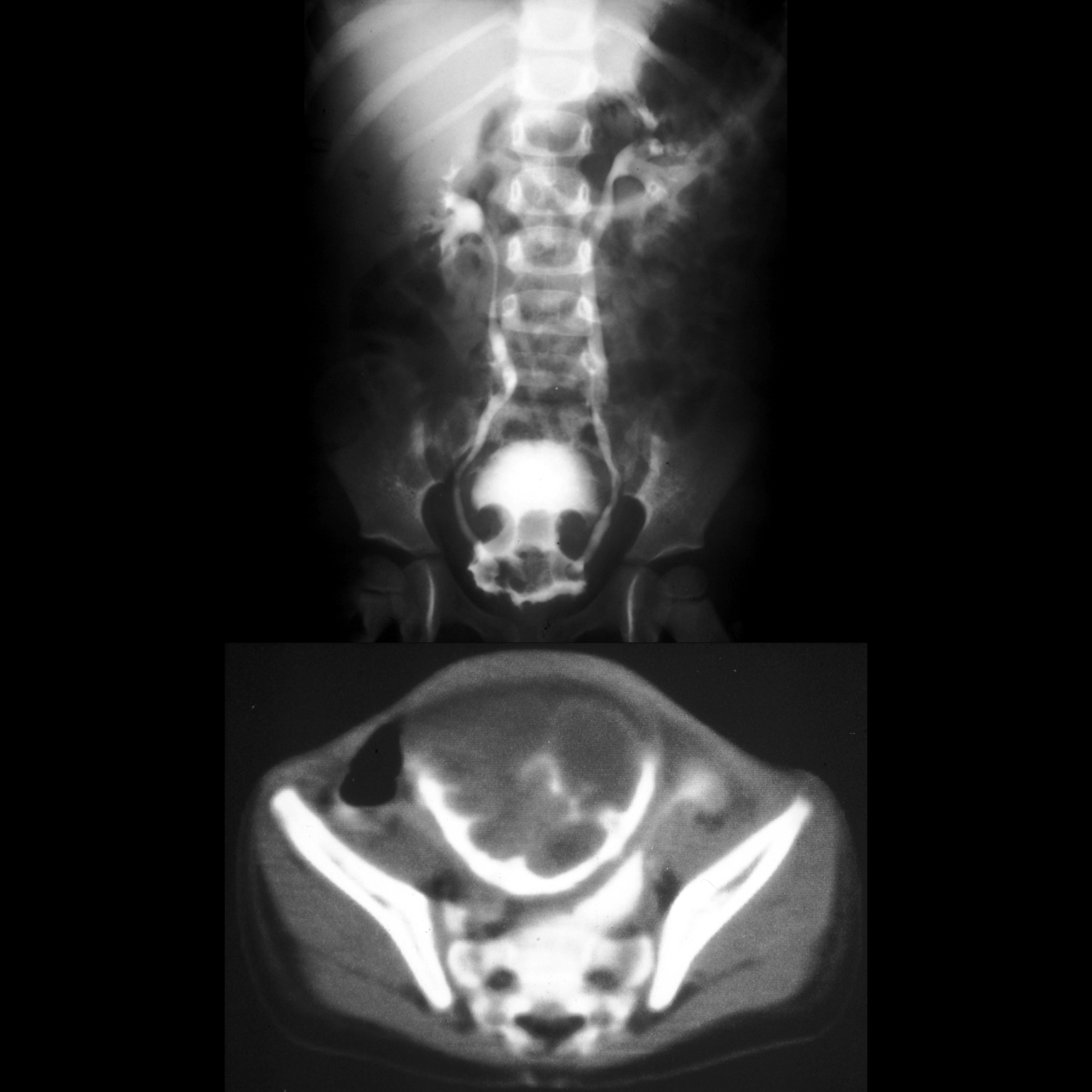 Pediatric Genitourinary Rhabdomyosarcoma | Pediatric Radiology ...