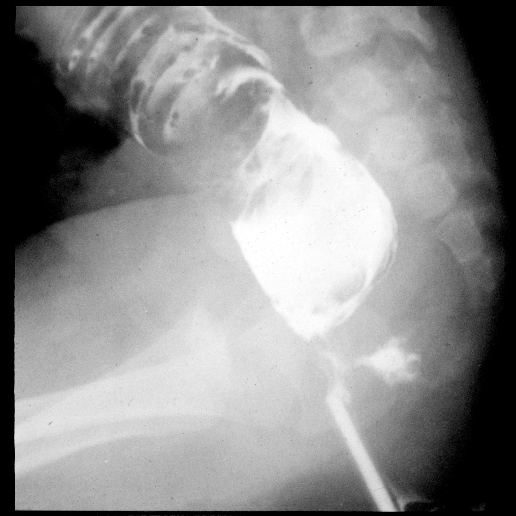 Sacrococcygeal Teratoma | Pediatric Radiology Reference Article ...
