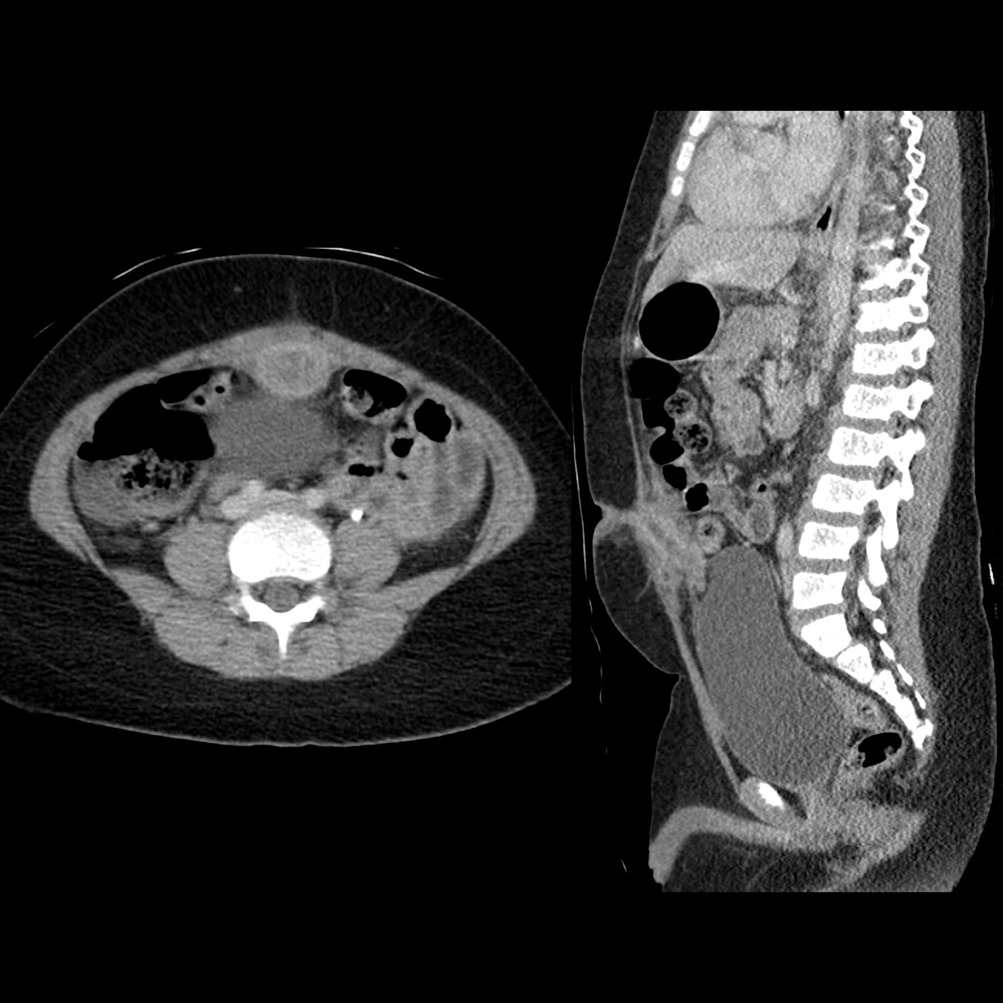Pediatric Urachal Remnant | Pediatric Radiology Reference Article ...