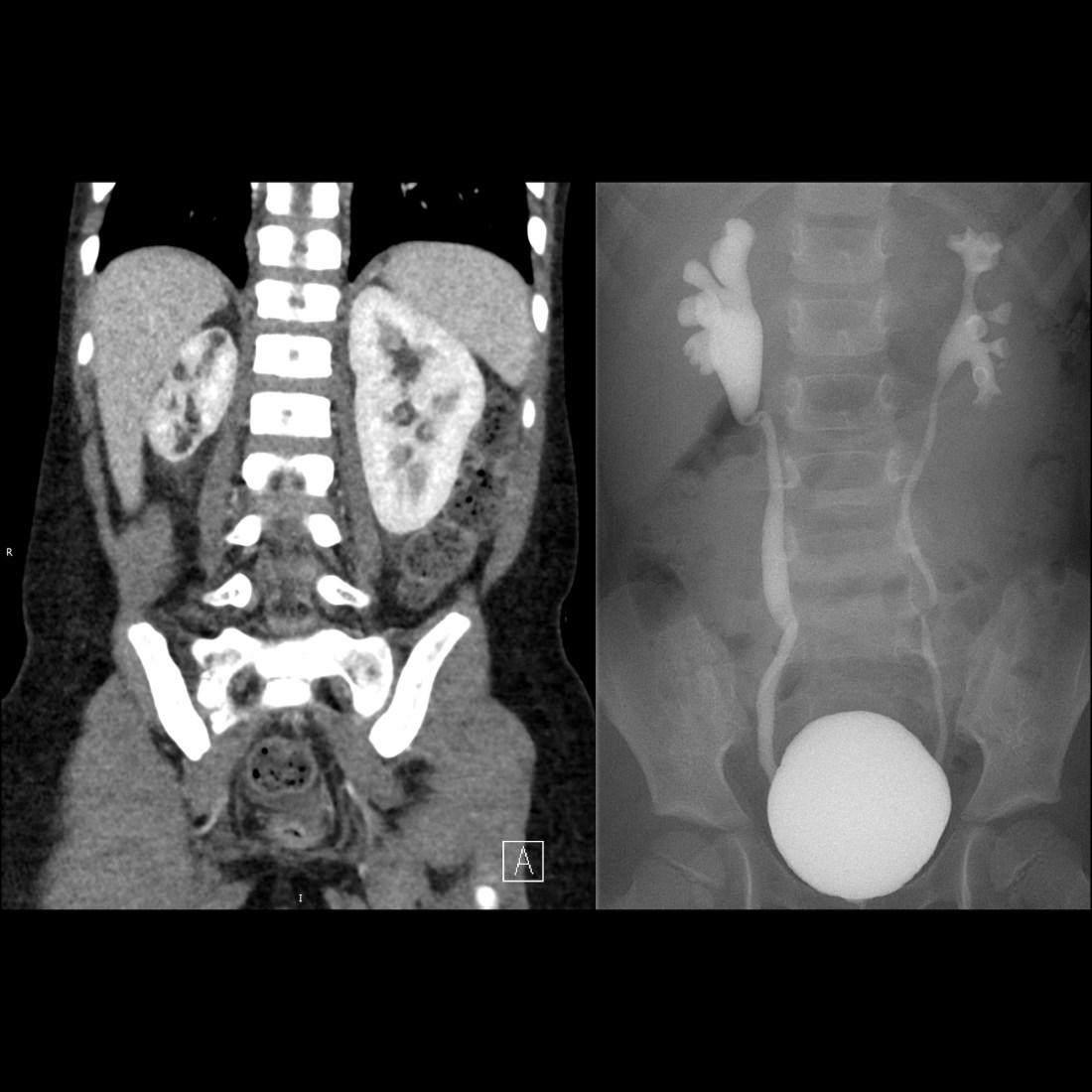 Pediatric Chronic Pyelonephritis | Pediatric Radiology Reference ...