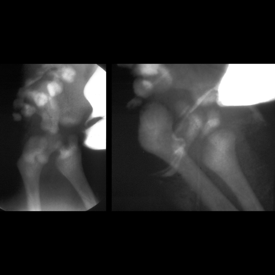 Cloacal Malformation | Pediatric Radiology Reference Article ...