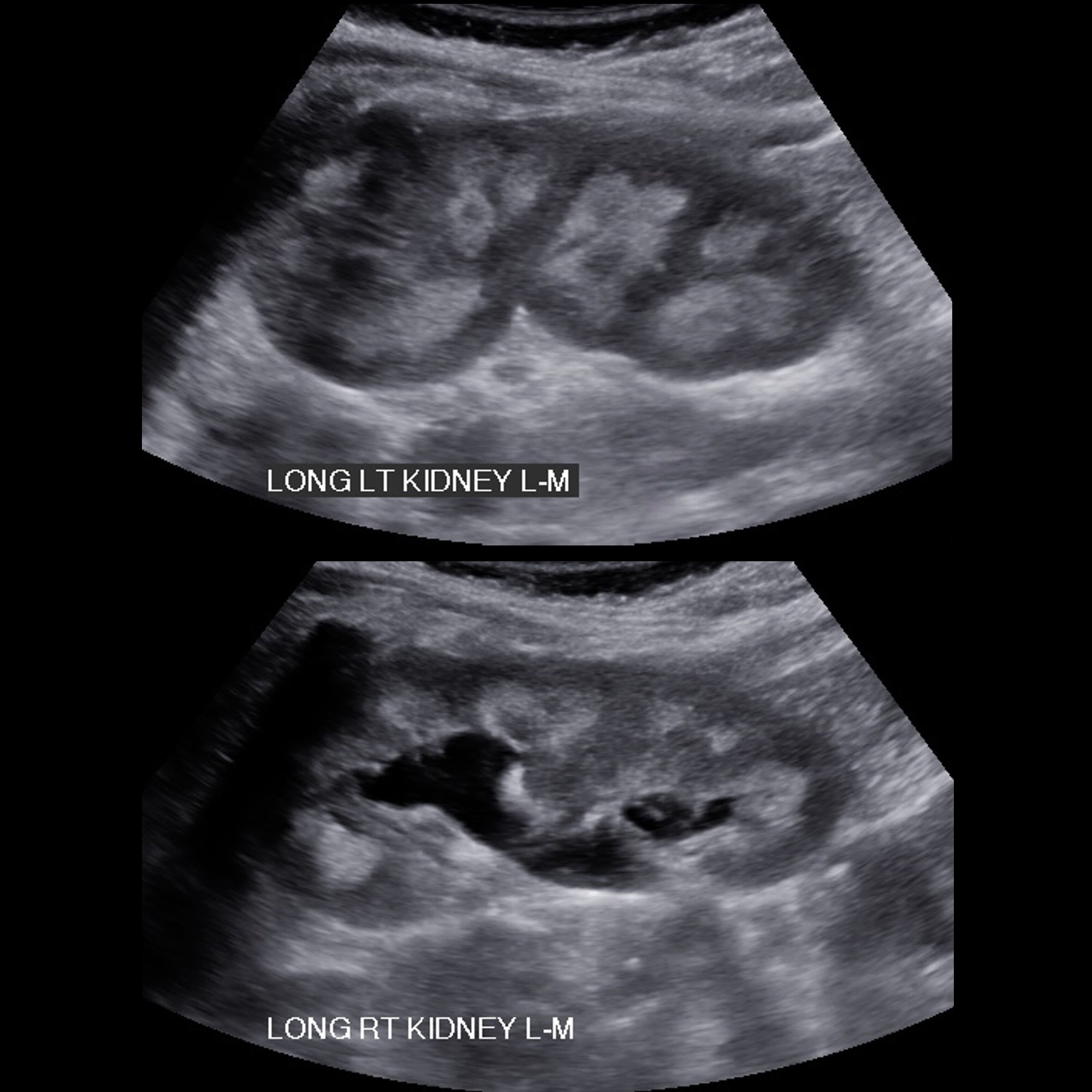 Pediatric Nephrocalcinosis | Pediatric Radiology Reference Article ...