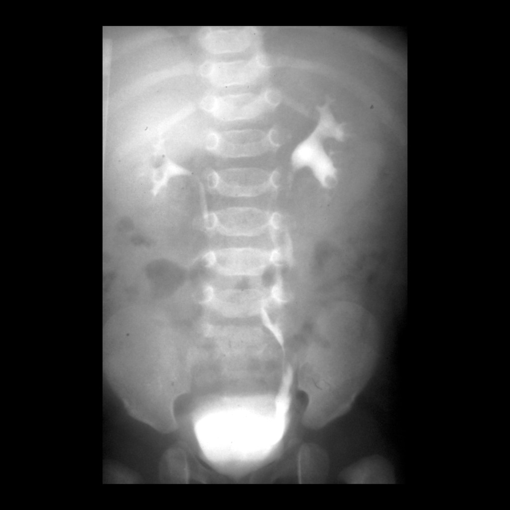 Congenital Megaureter | Pediatric Radiology Reference Article ...