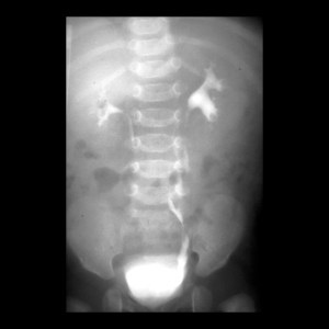Congenital Megaureter | Pediatric Radiology Reference Article ...