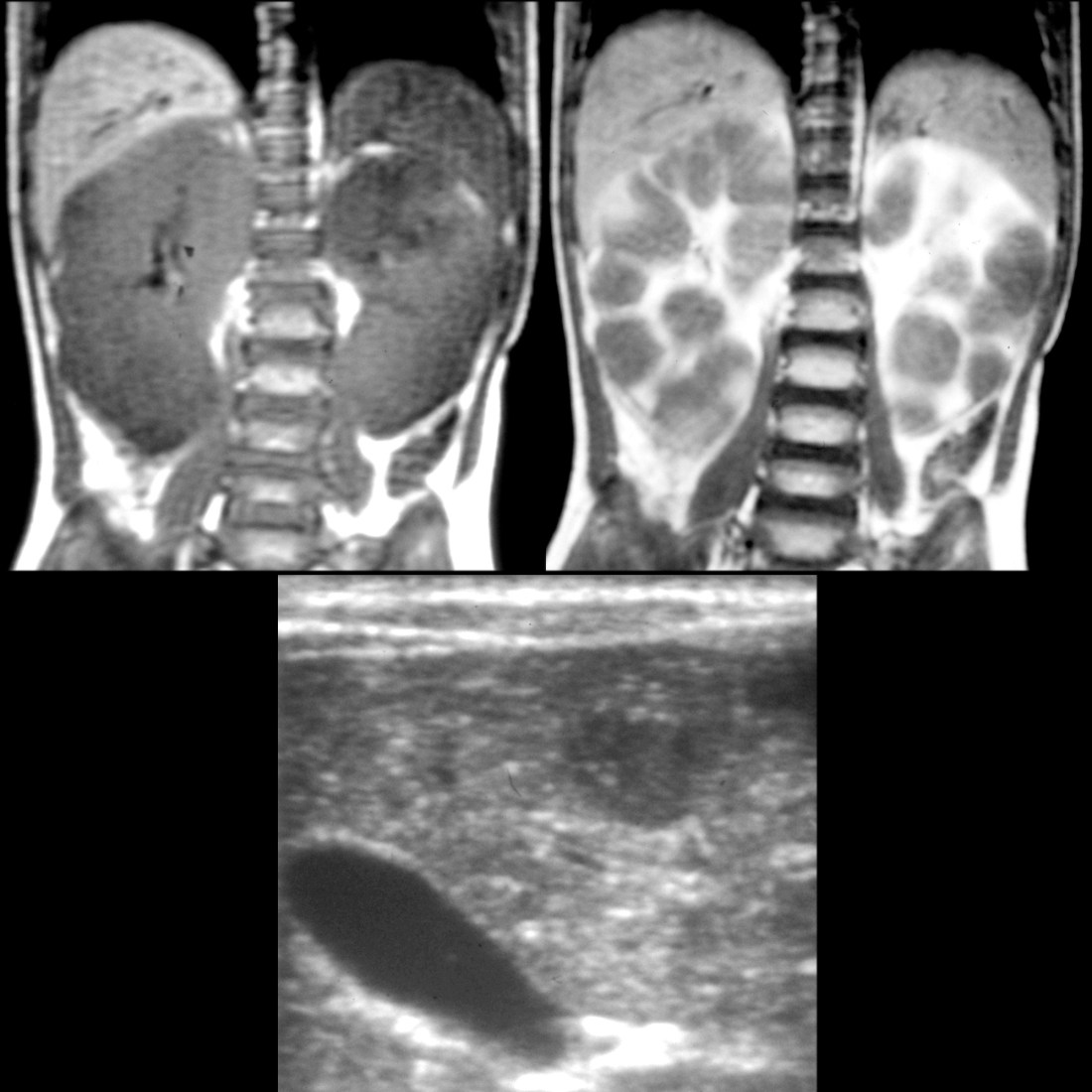 Pediatric Burkitt Lymphoma | Pediatric Radiology Reference Article ...