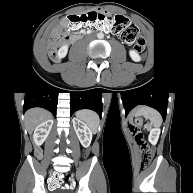 Undescended Testicle Image Radiopaediaorg
