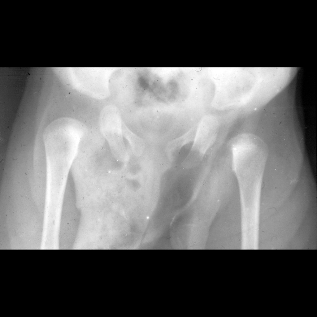 Pediatric Inguinal Hernia | Pediatric Radiology Reference Article ...