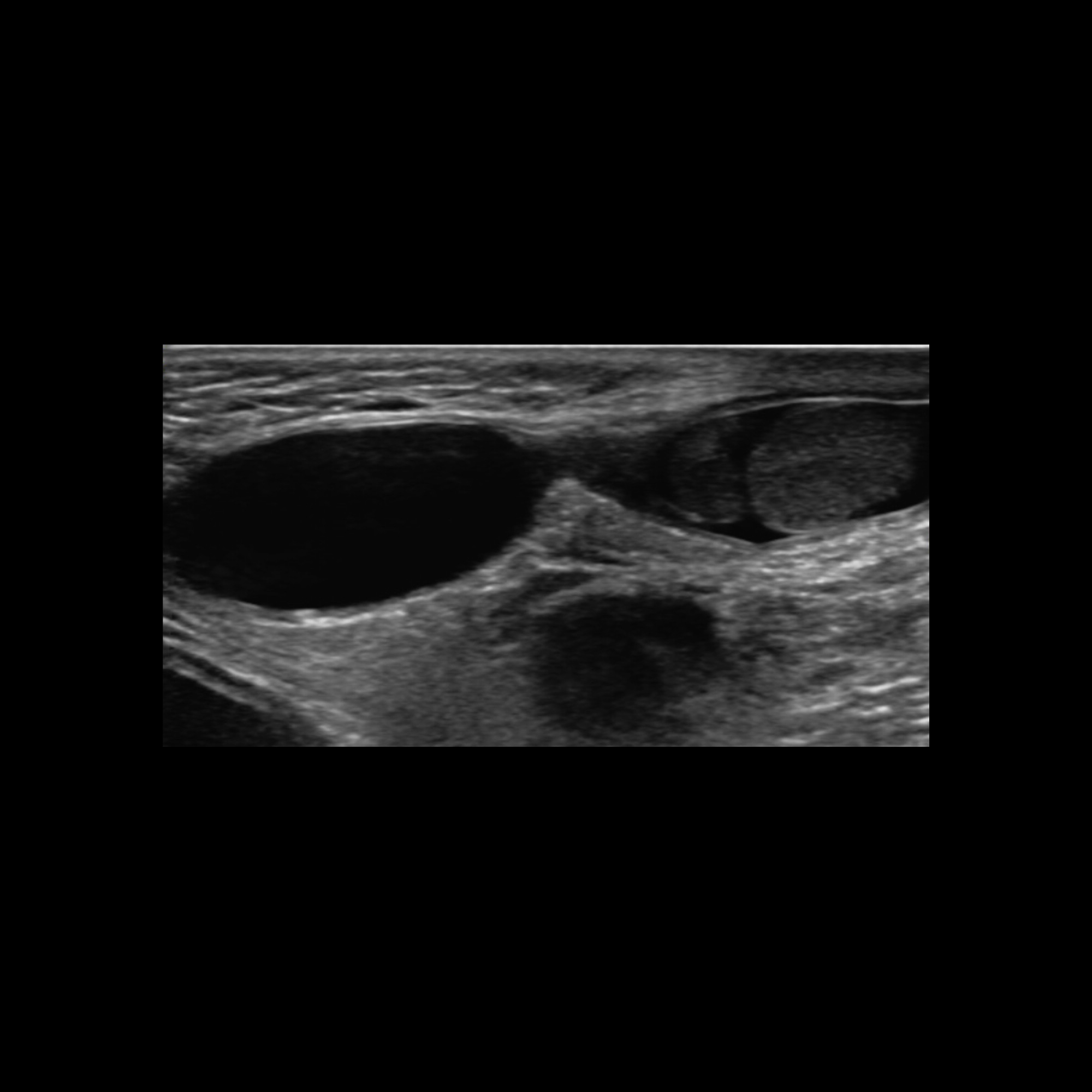 Hydrocele of Spermatic Cord | Pediatric Radiology Reference Article ...