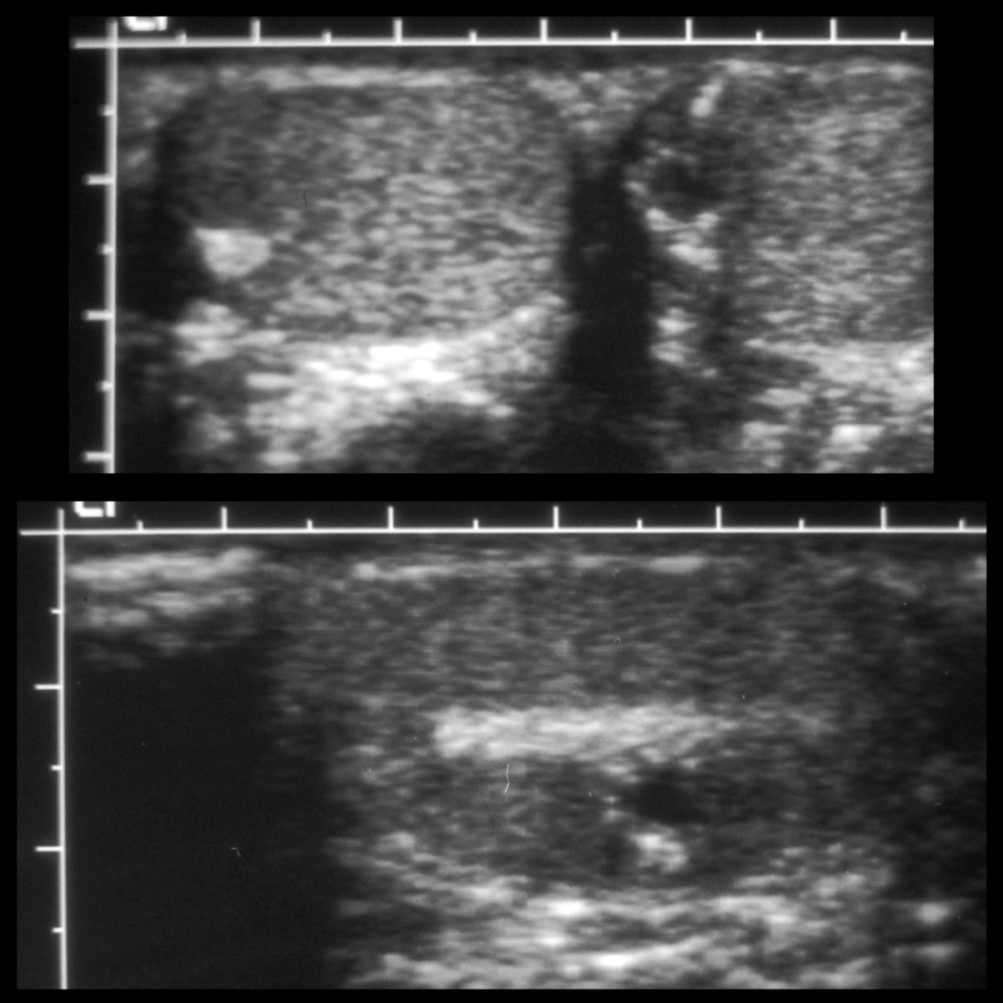 Pediatric Testicle Tumor | Pediatric Radiology Reference Article ...