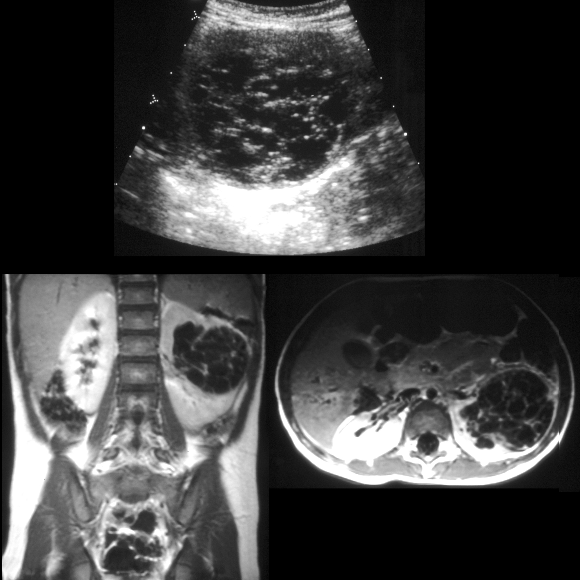 Pediatric Cystic Nephroma | Pediatric Radiology Reference Article ...