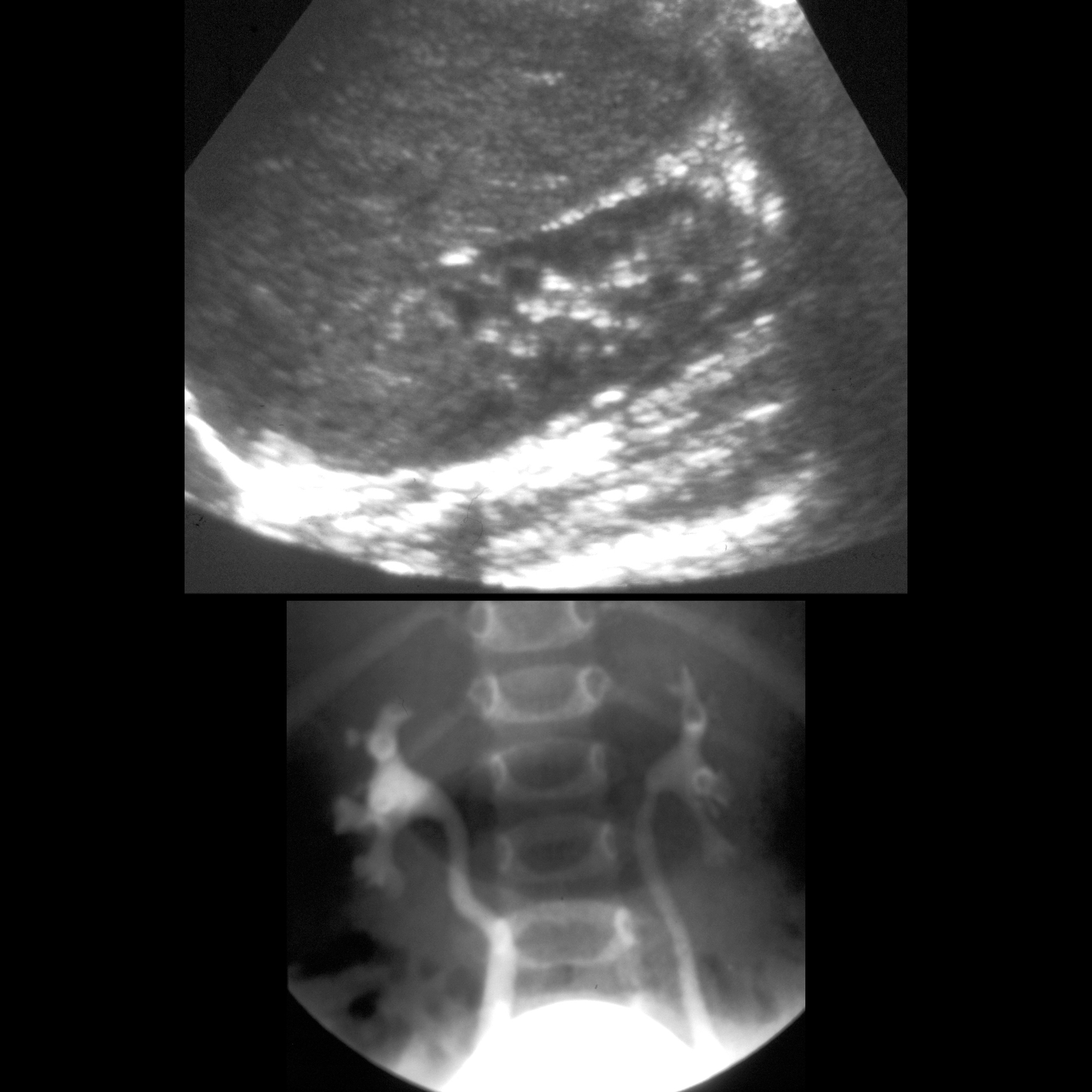 Pediatric Acute Pyelonephritis | Pediatric Radiology Reference Article ...