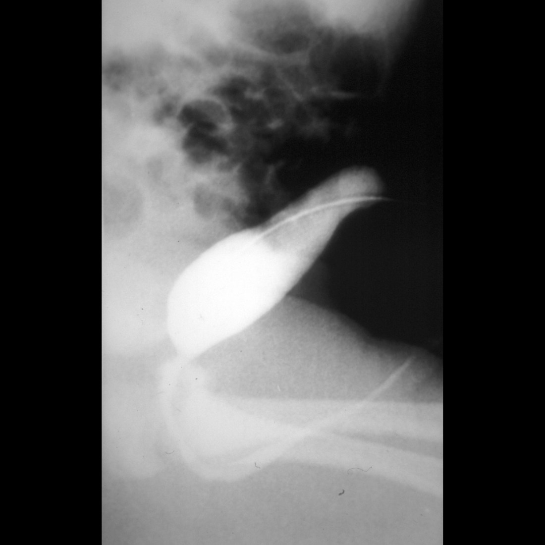 Pediatric Urachal Remnant | Pediatric Radiology Reference Article ...