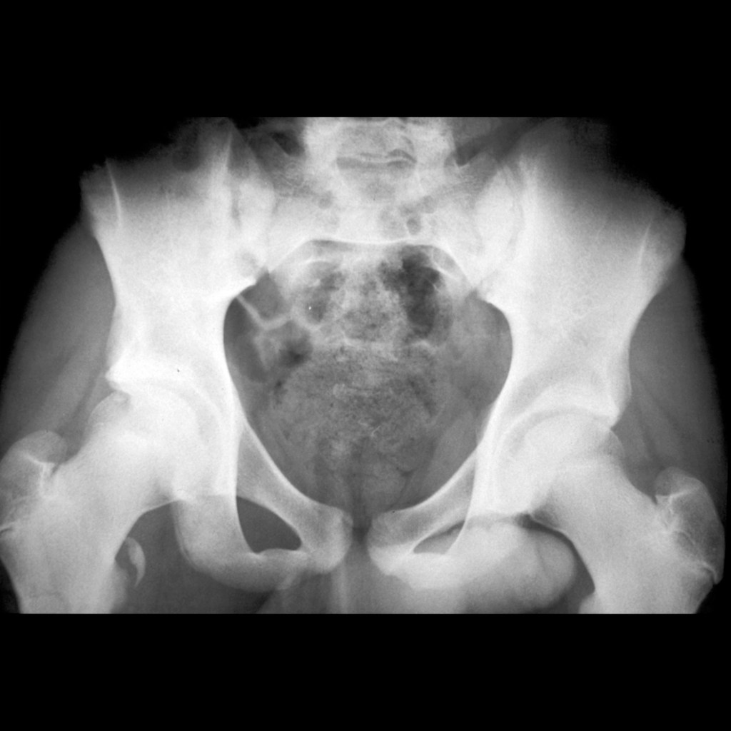 Pediatric Pelvis and Hip Apophyseal Avulsion Fracture | Pediatric ...