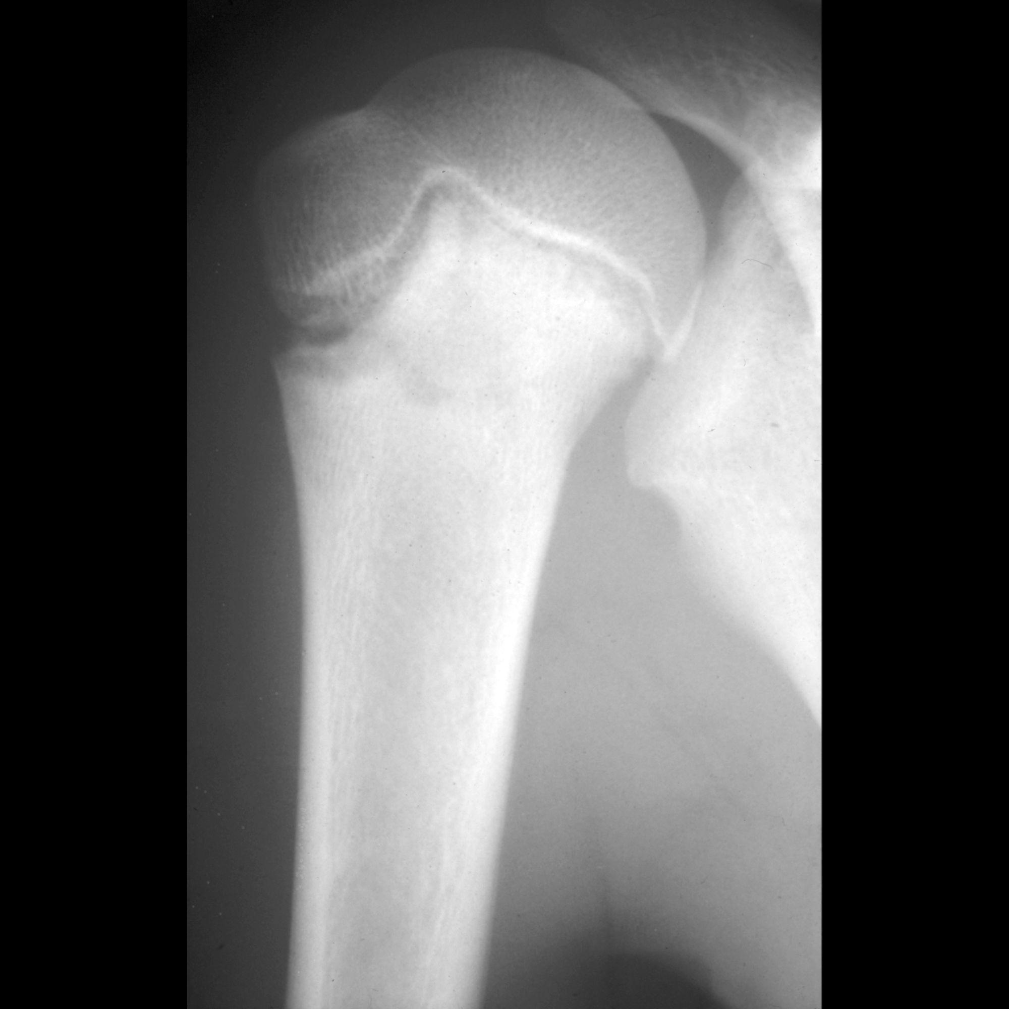 Little Leaguer Shoulder | Pediatric Radiology Reference Article ...