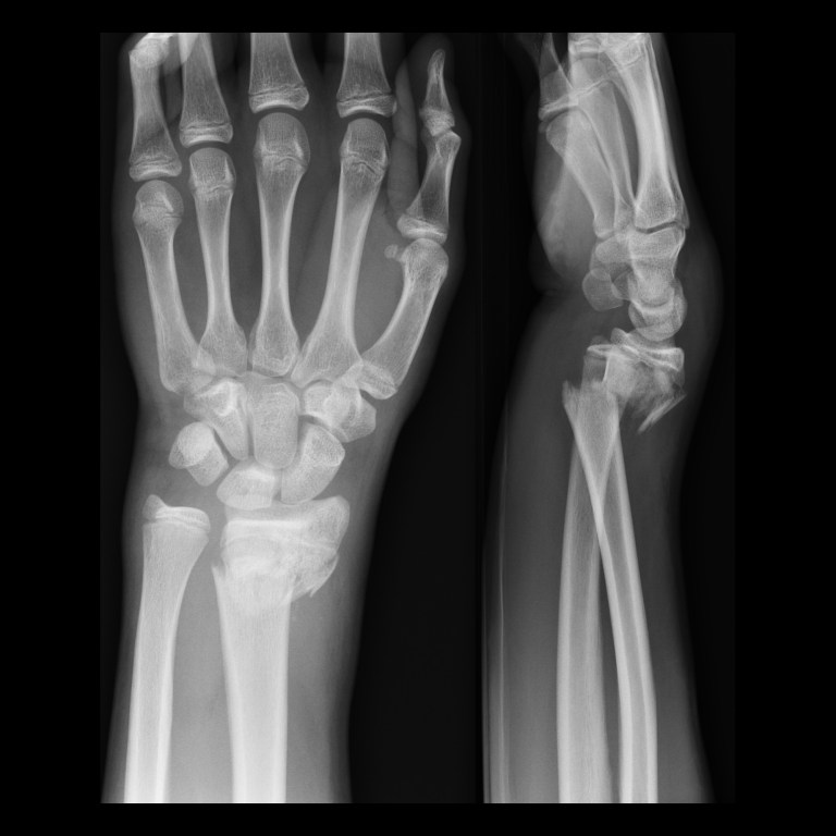 Pediatric Colles Fracture | Pediatric Radiology Reference Article ...