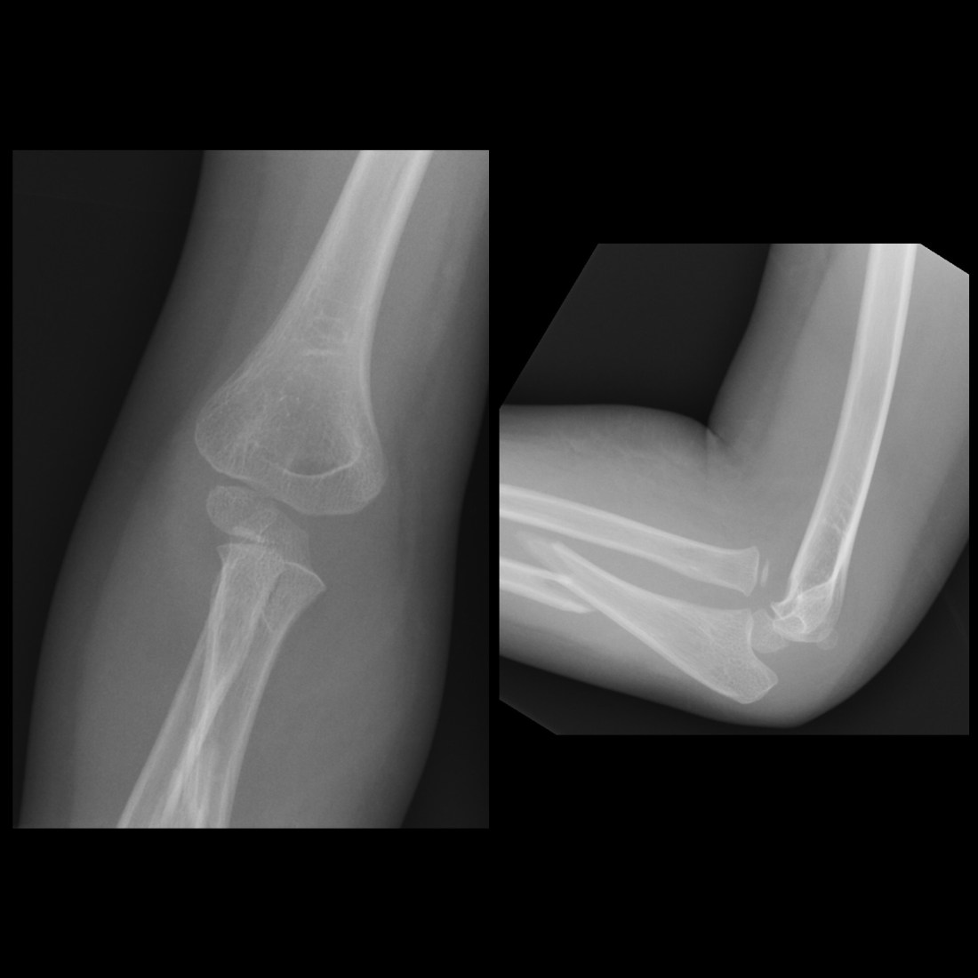 Preschooler with forearm pain after a fall | Pediatric Radiology Case ...