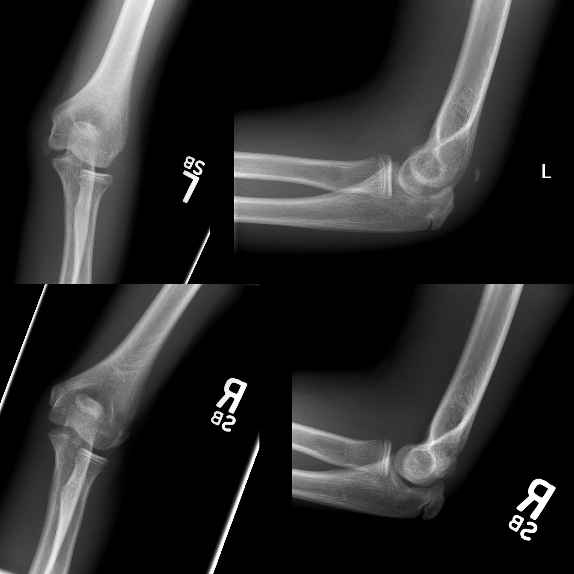 Pediatric Elbow Fracture | Pediatric Radiology Reference Article ...
