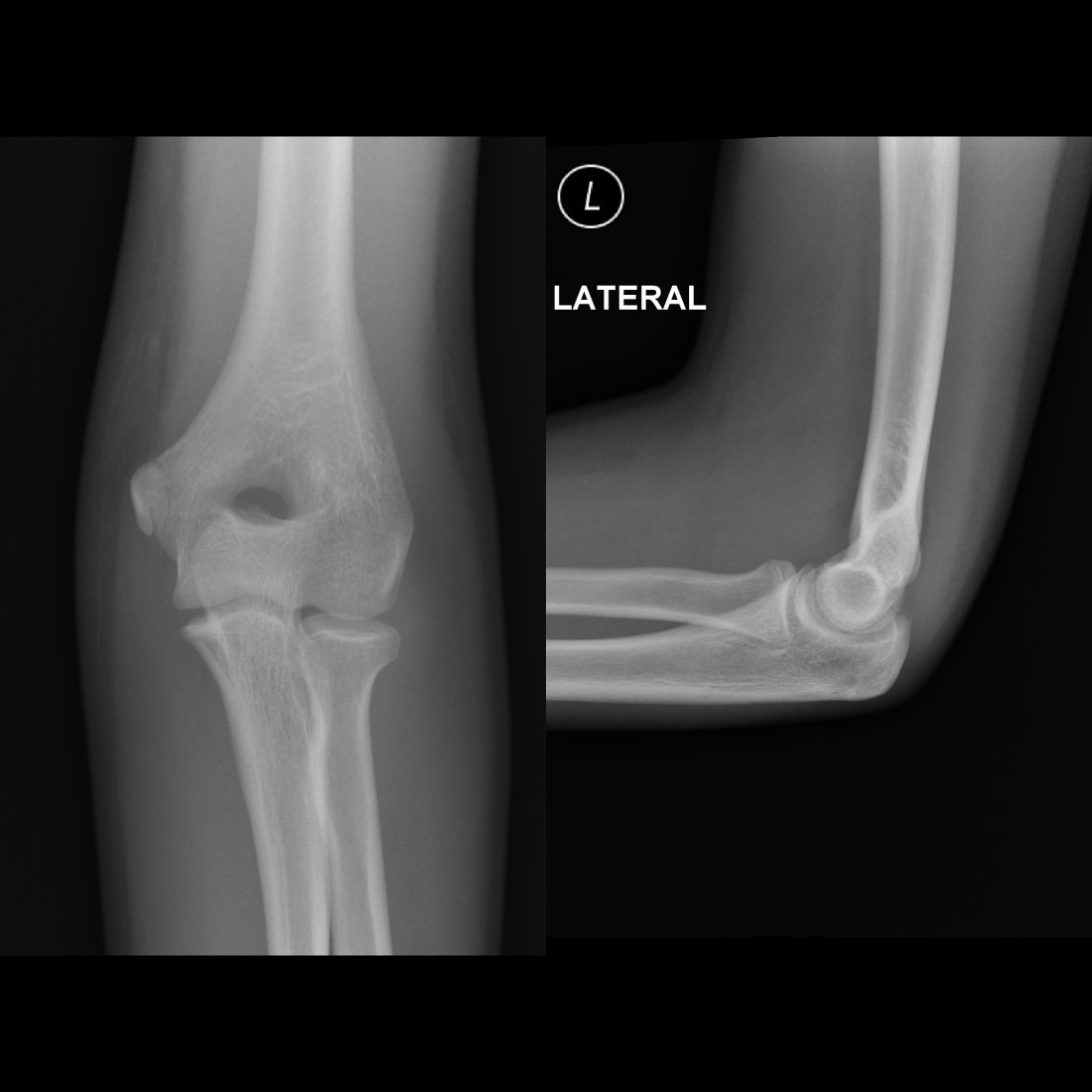 Pediatric Elbow Fracture | Pediatric Radiology Reference Article ...