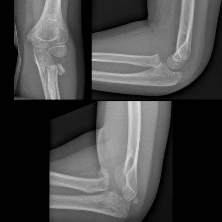 Pediatric Elbow Fracture | Pediatric Radiology Reference Article ...
