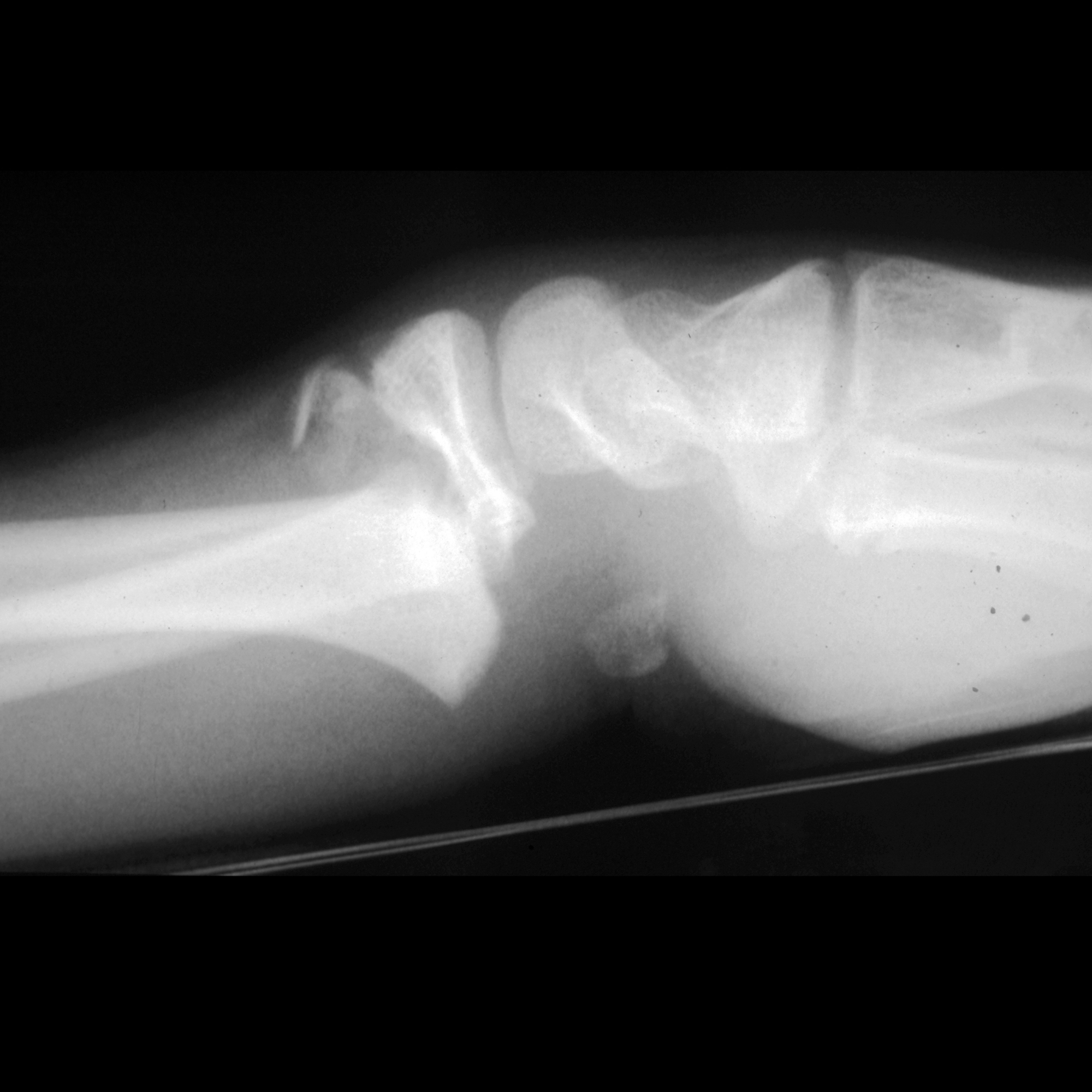 Salter-Harris Fracture | Pediatric Radiology Reference Article ...