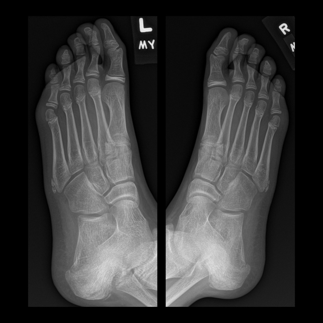 Pediatric Fifth Metatarsal Apophysis Fracture | Pediatric Radiology ...