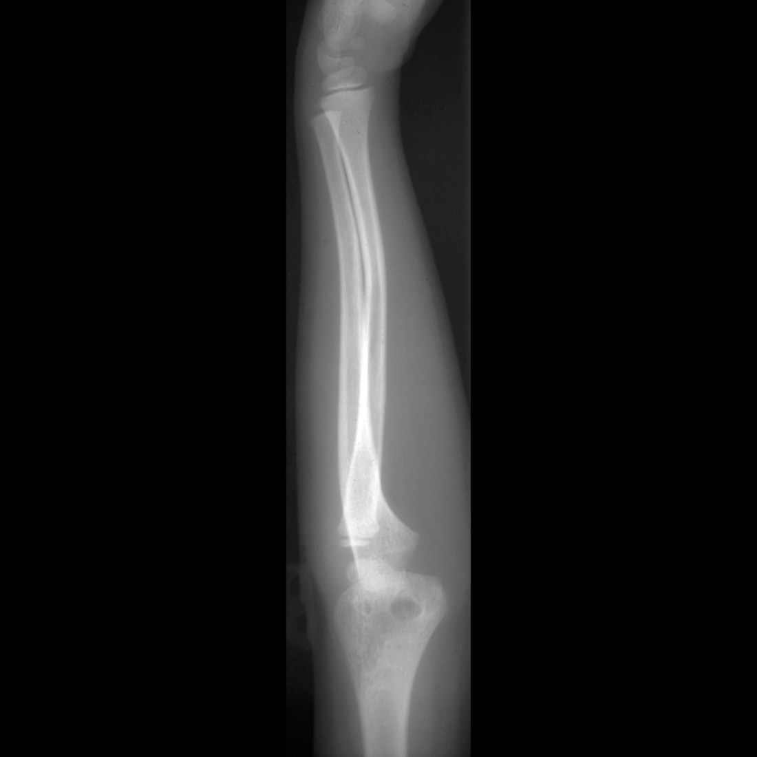 School ager with trauma to the forearm | Pediatric Radiology Case ...