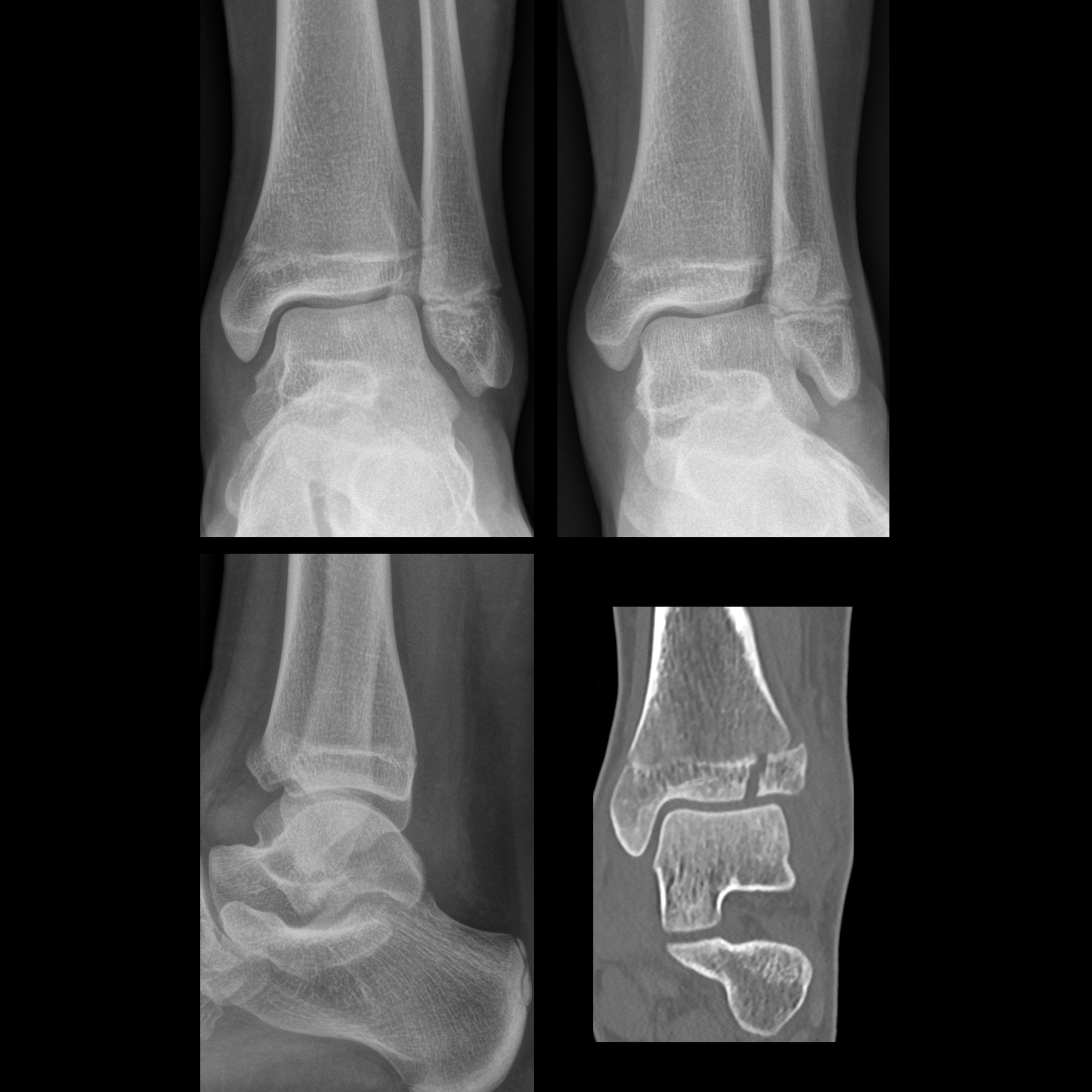 Tillaux Fracture | Pediatric Radiology Reference Article | Pediatric ...