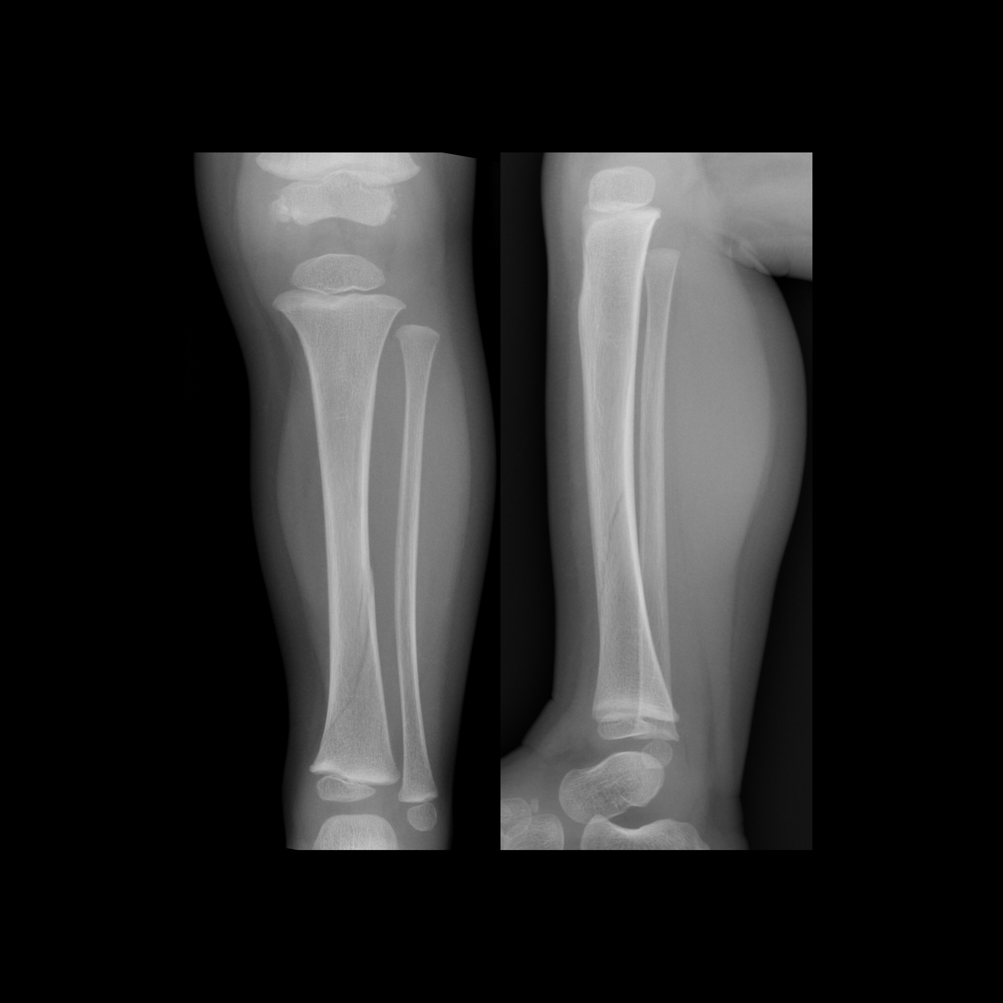 Toddler Fracture | Pediatric Radiology Reference Article | Pediatric ...