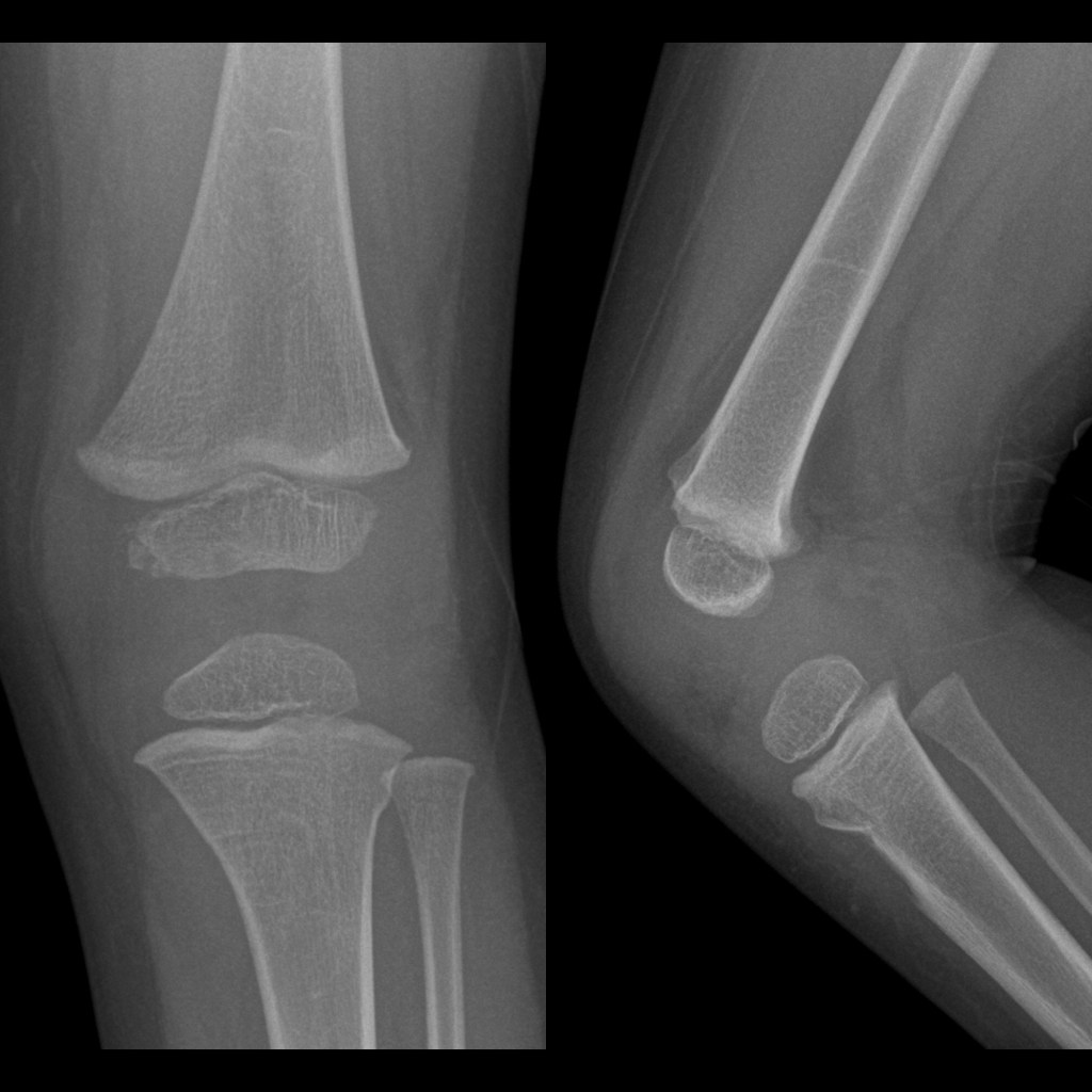 Trampoline Fracture | Pediatric Radiology Reference Article | Pediatric ...