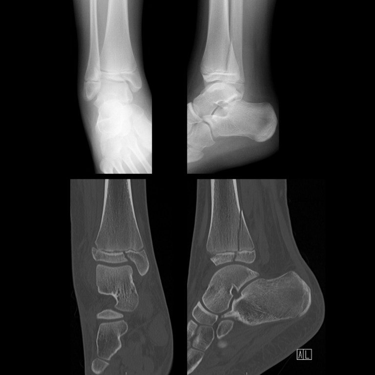 Triplane Fracture | Pediatric Radiology Reference Article | Pediatric ...