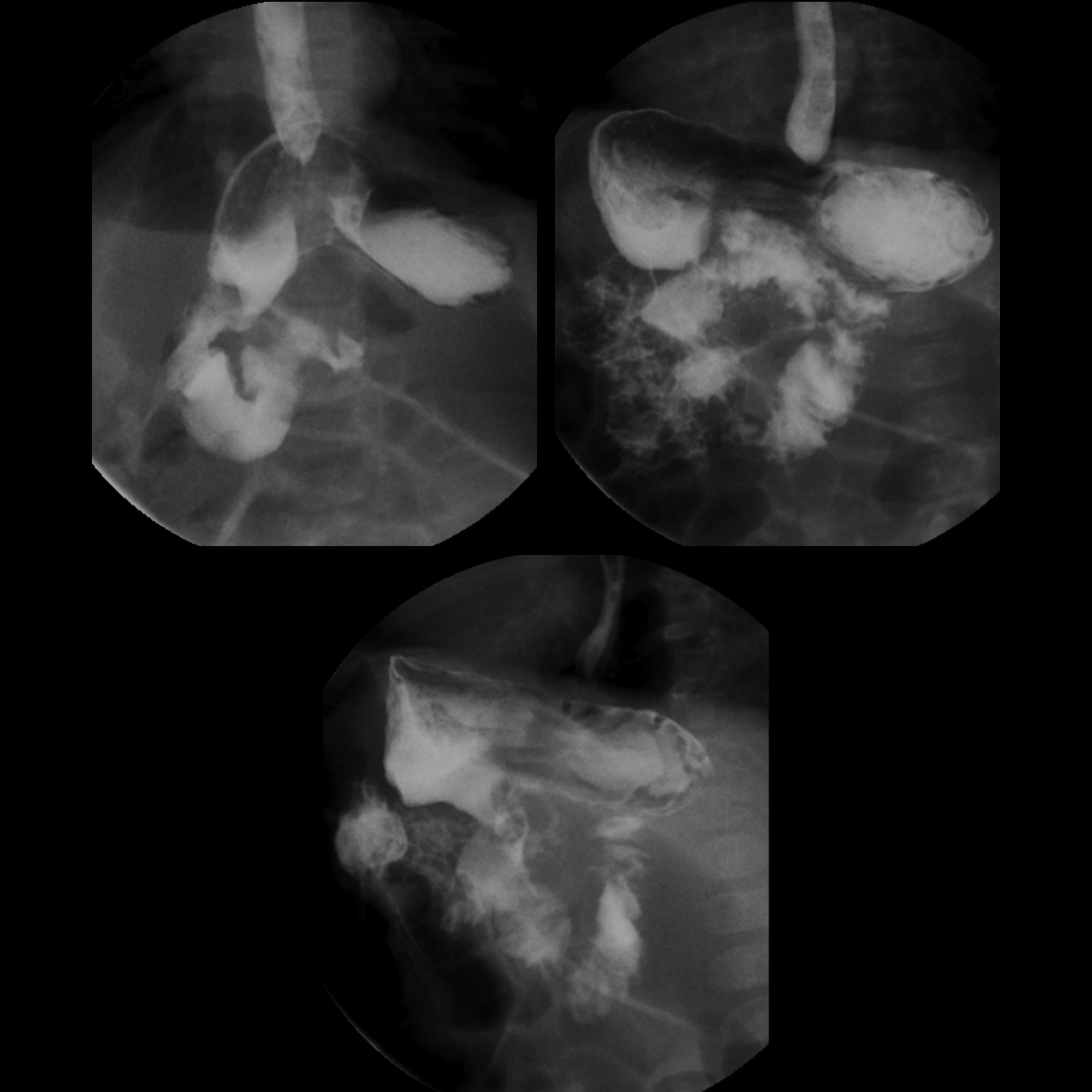 Pediatric Organoaxial Gastric Volvulus | Pediatric Radiology Reference ...