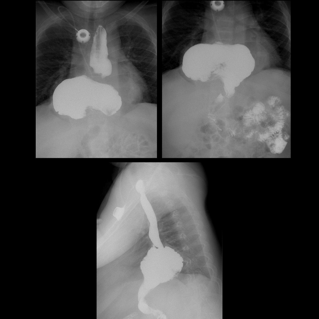 Pediatric Organoaxial Gastric Volvulus | Pediatric Radiology Reference ...