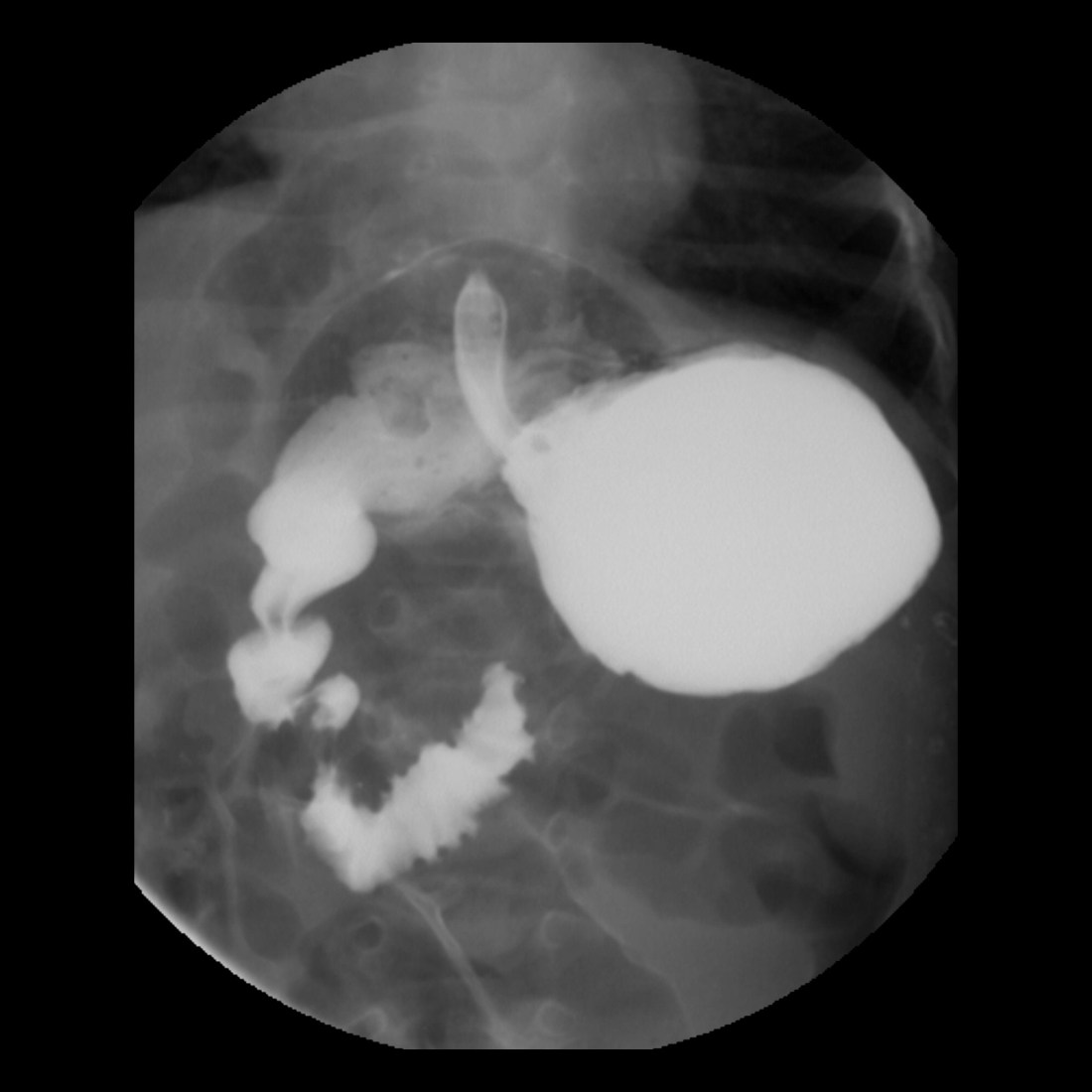 Pediatric Organoaxial Gastric Volvulus | Pediatric Radiology Reference ...