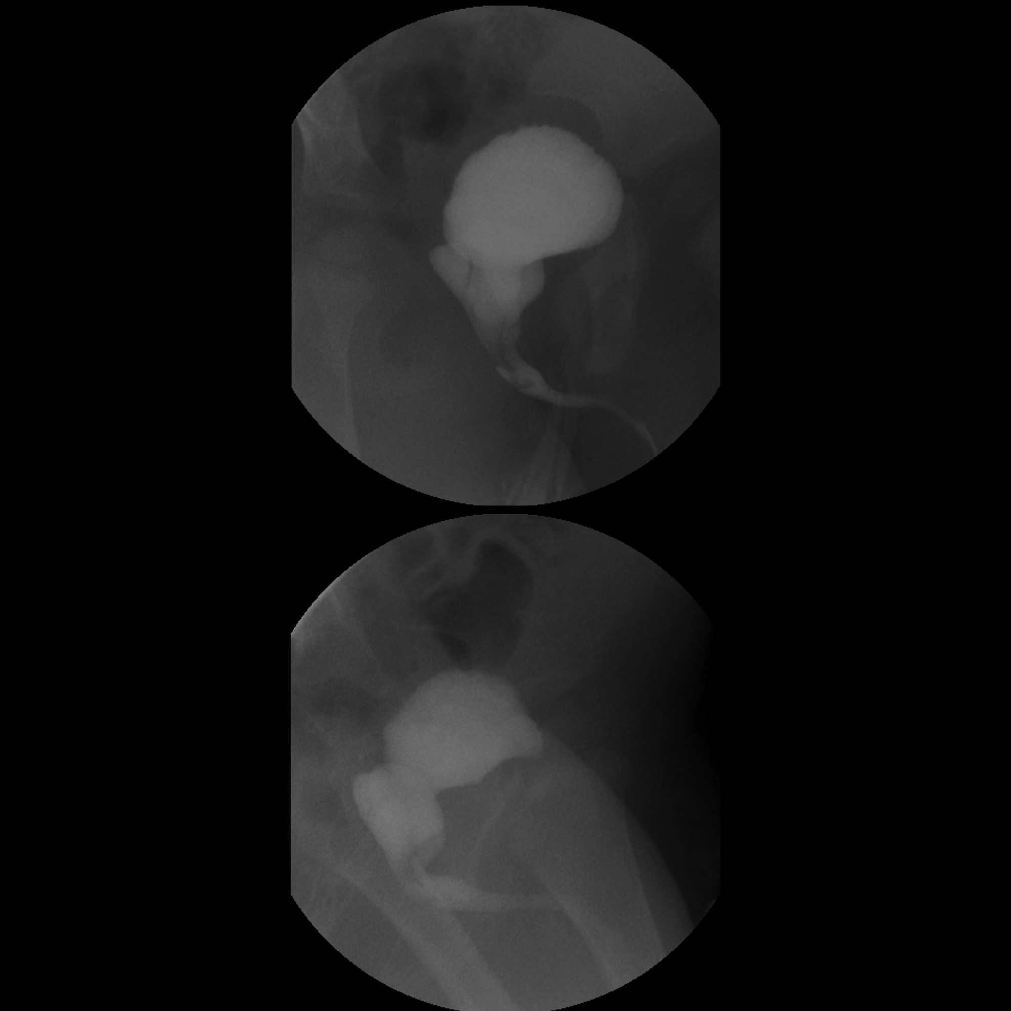Pediatric Prostatic Utricle Cyst | Pediatric Radiology Reference ...