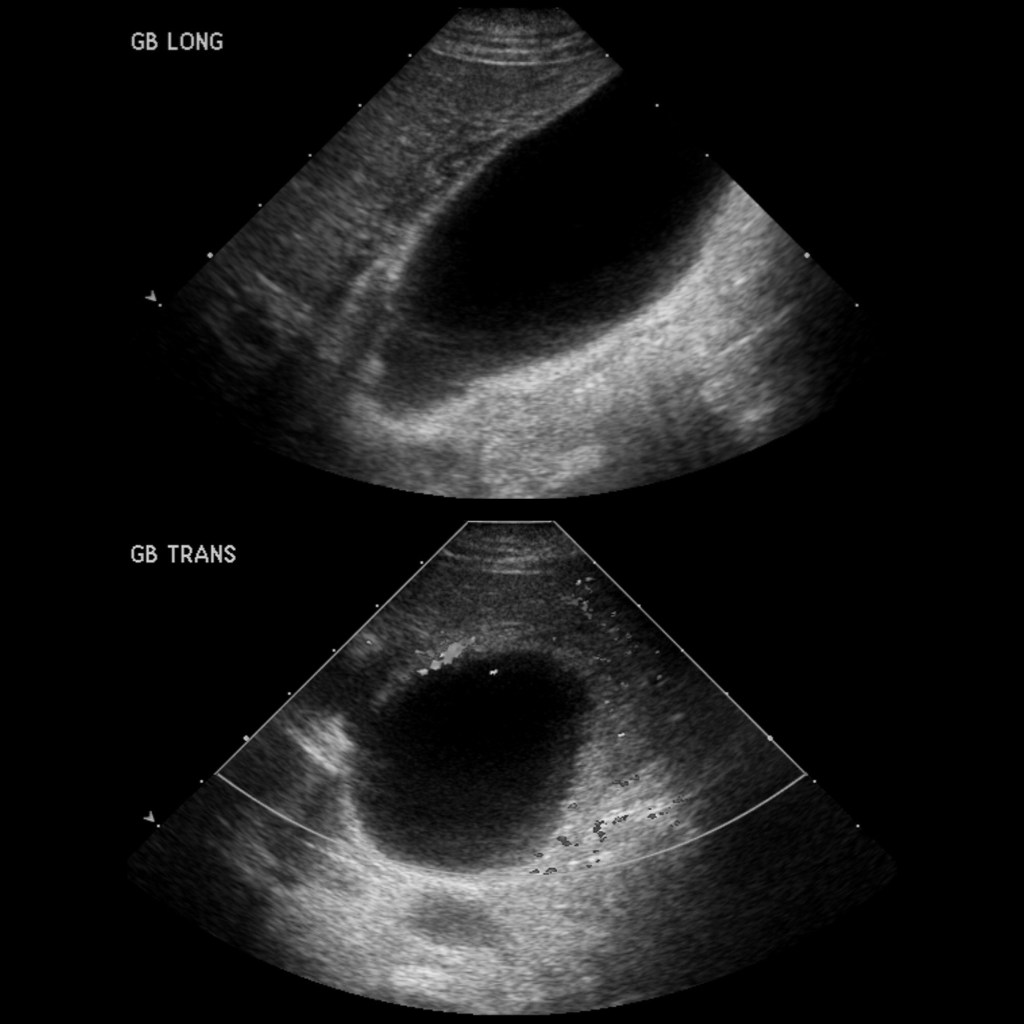 Kawasaki Disease | Pediatric Radiology Reference Article | Pediatric ...