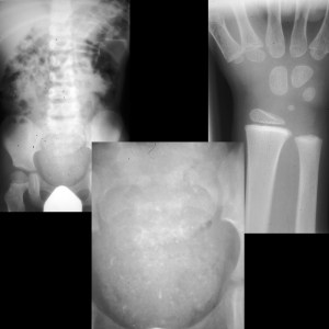 Lead Poisoning | Pediatric Radiology Reference Article | Pediatric ...