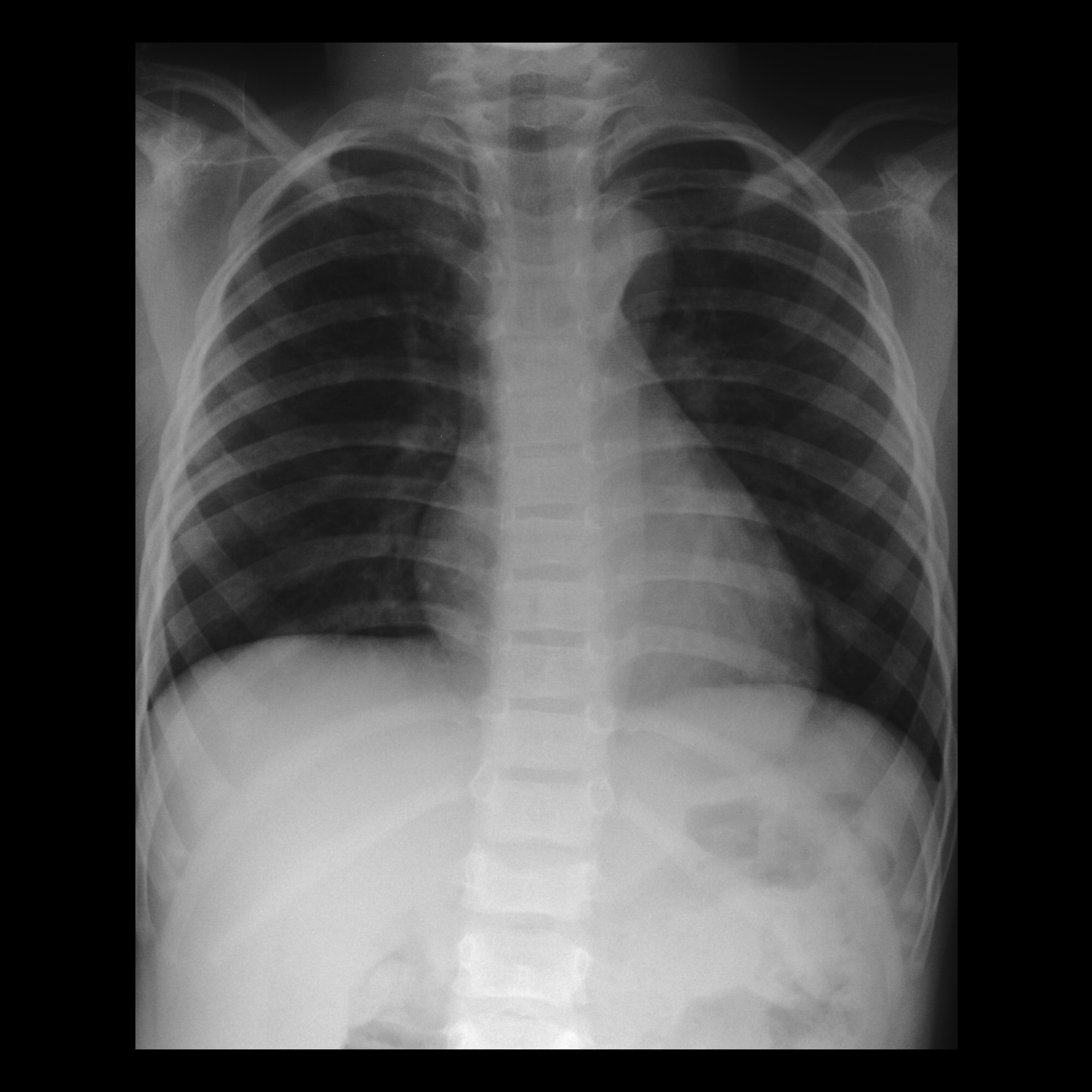 Marfan Syndrome Chest X Ray PDF] Pectus Updates And Special