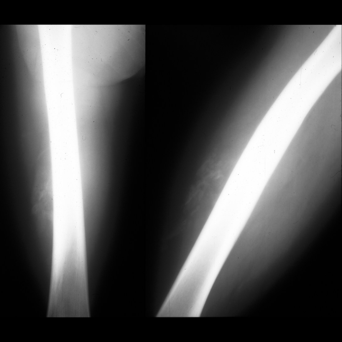 Pediatric Myositis Ossificans | Pediatric Radiology Reference Article ...