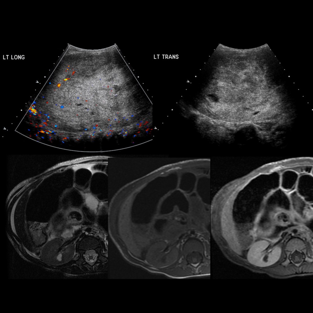 Nephroblastomatosis | Pediatric Radiology Reference Article | Pediatric ...