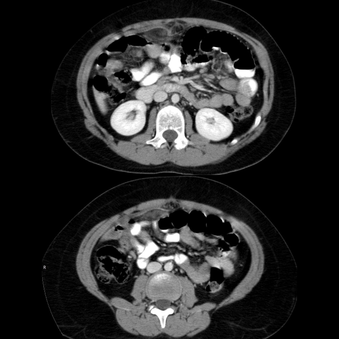 Pediatric Omental Infarction | Pediatric Radiology Reference Article ...