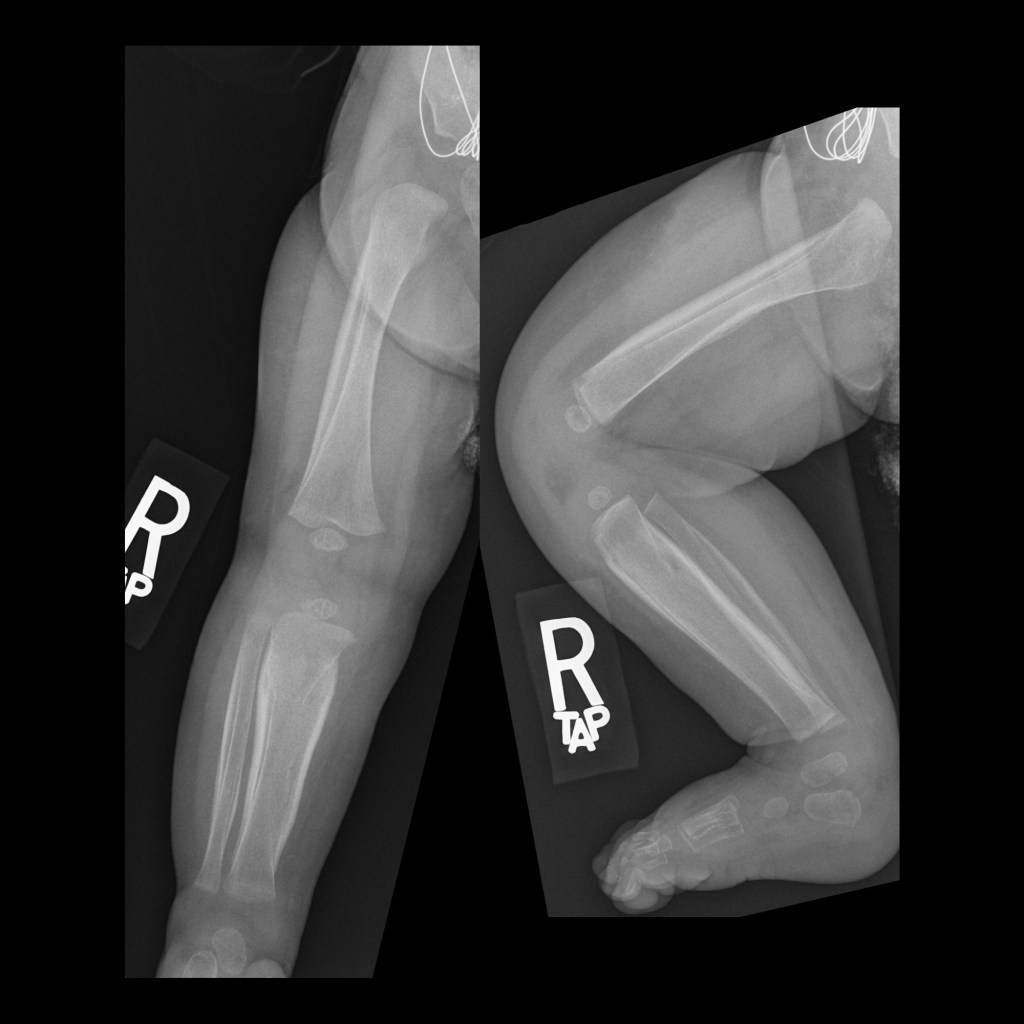Prostaglandin Osteopathy | Pediatric Radiology Reference Article ...