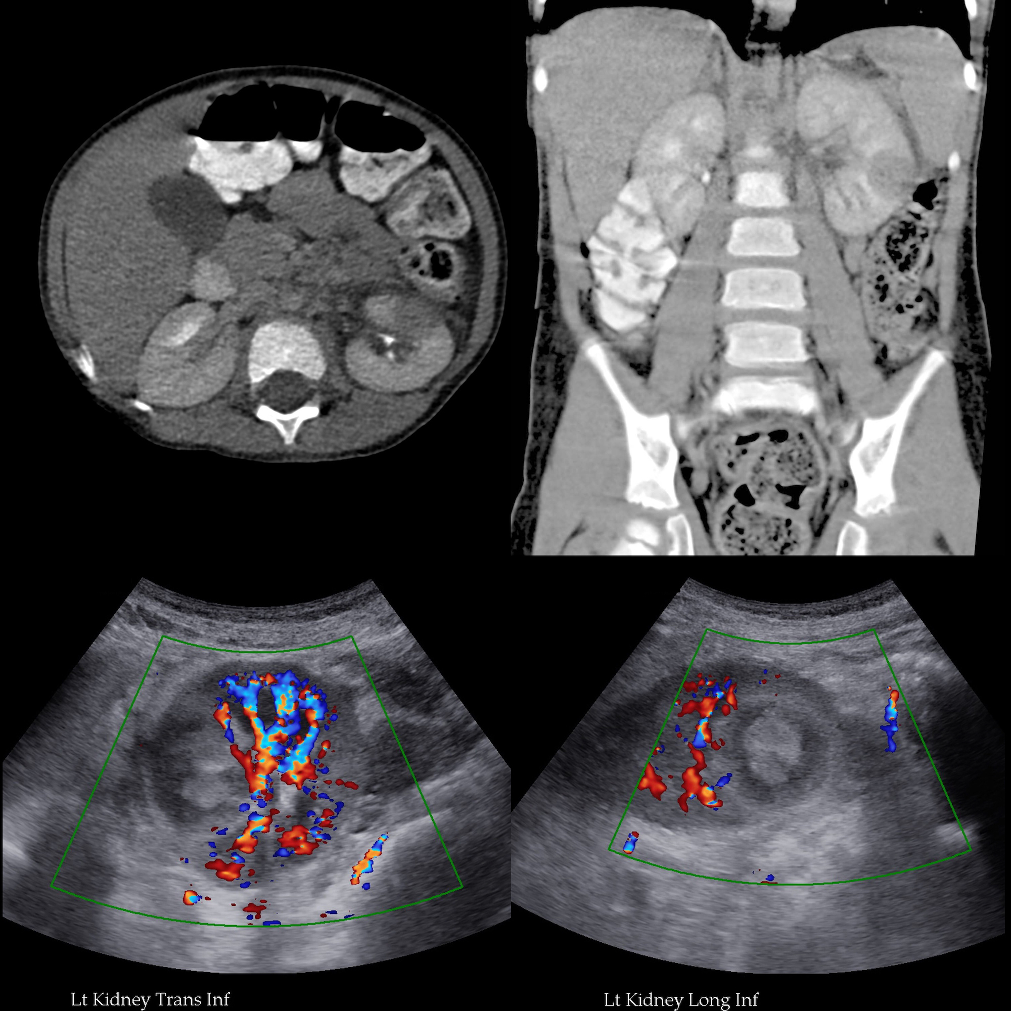 Pediatric Renal Abscess | Pediatric Radiology Reference Article ...