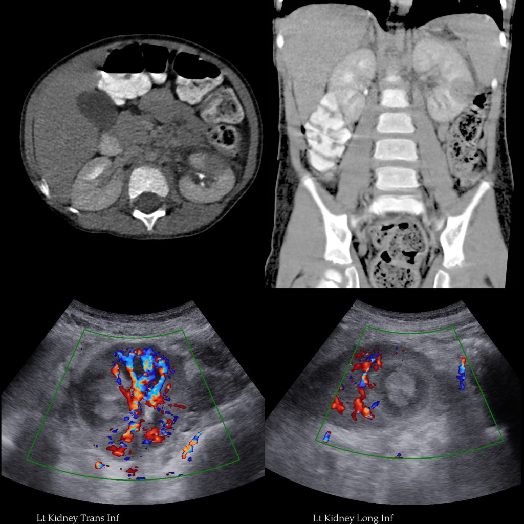 Pediatric Renal Abscess | Pediatric Radiology Reference Article ...