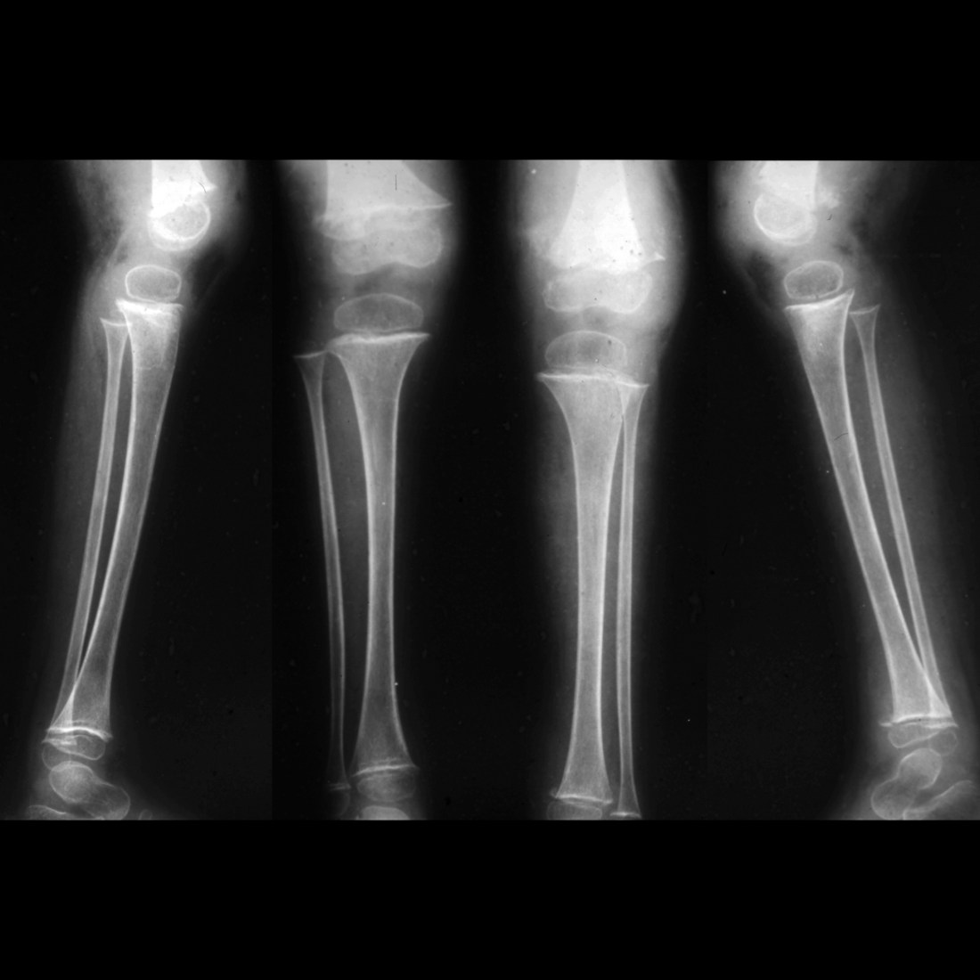 Scurvy | Pediatric Radiology Reference Article | Pediatric Imaging ...
