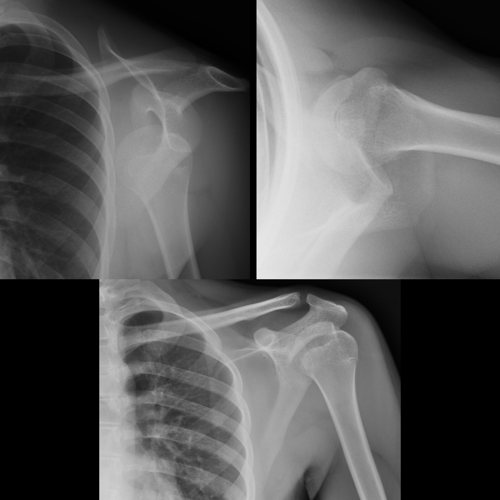 Pediatric Anterior Shoulder Dislocation | Pediatric Radiology Reference ...