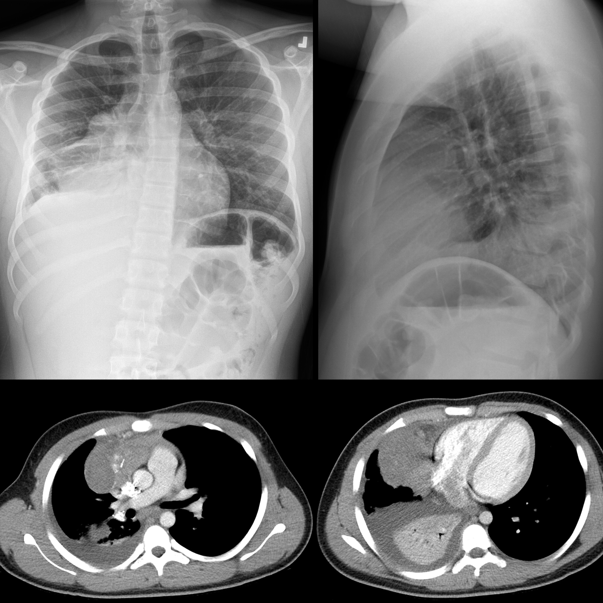 Pediatric Thymoma | Pediatric Radiology Reference Article | Pediatric ...