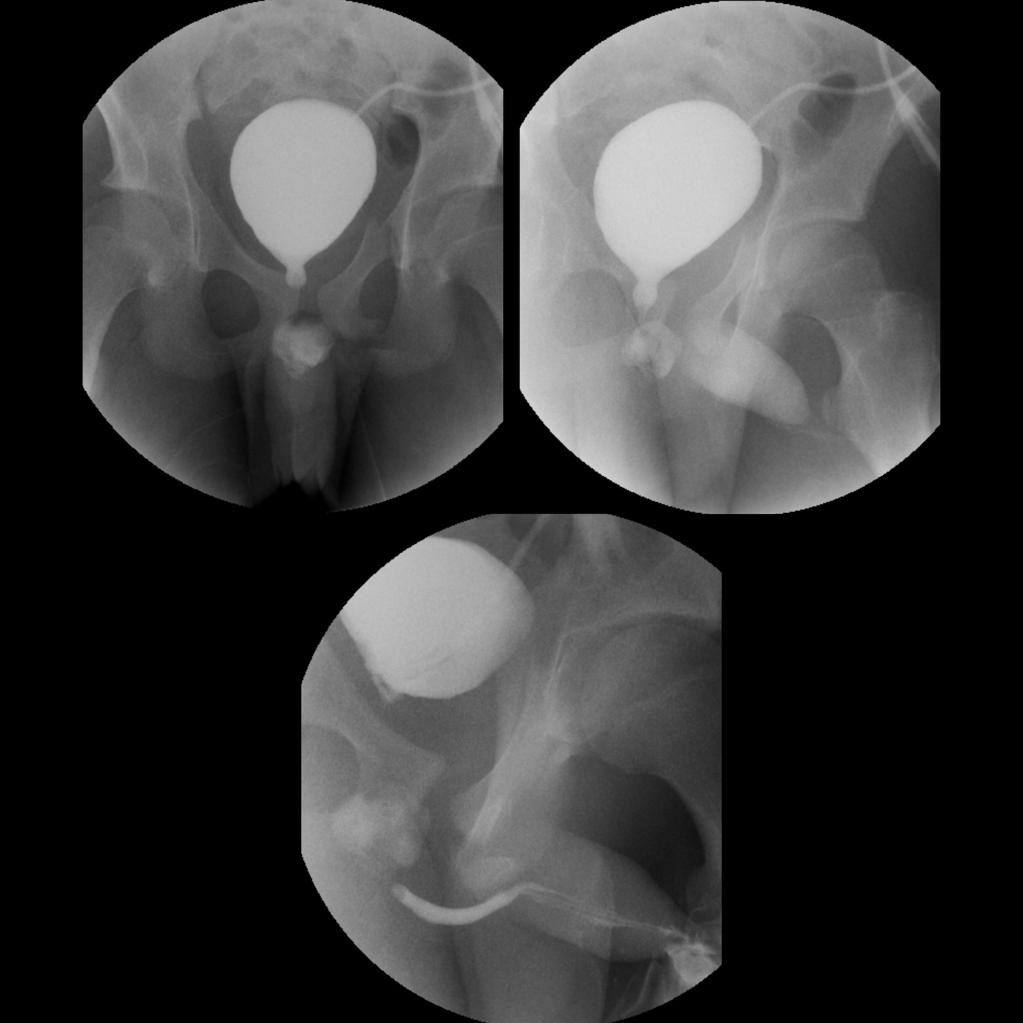Pediatric Urethral Trauma | Pediatric Radiology Reference Article ...