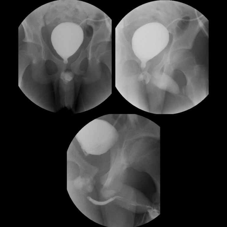 Pediatric Urethral Trauma | Pediatric Radiology Reference Article ...